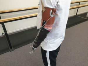 Upper Limb Prosthetics | Ability Prosthetics and Orthotics